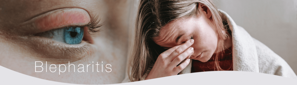 Blepharitis - Eyecare Virginia Beach