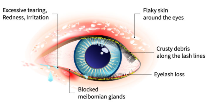 Blepharitis - Eyecare Virginia Beach