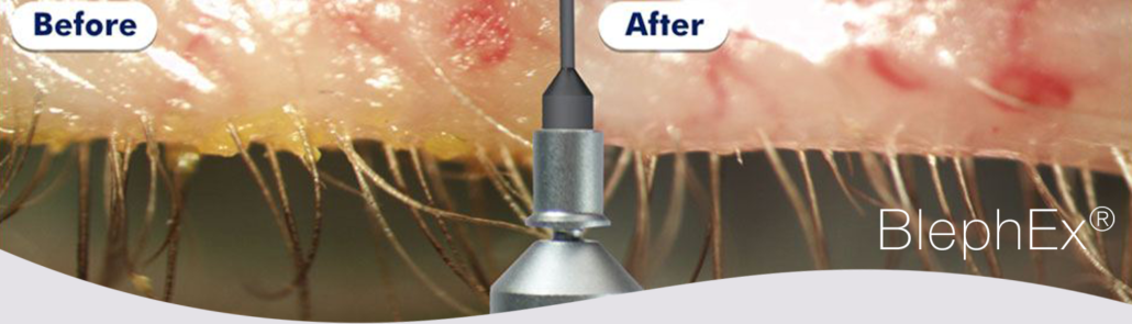 BlephEx® - Eyecare Virginia Beach