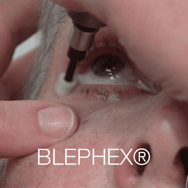 BlephEx® - Eyecare Virginia Beach