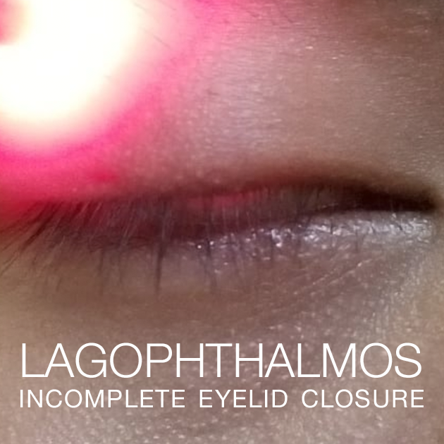 Lagophthalmos - Eyecare Virginia Beach