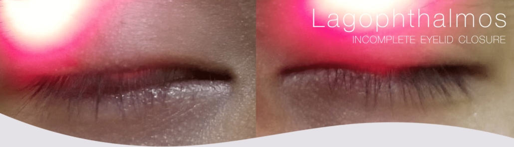 Lagophthalmos - Eyecare Virginia Beach