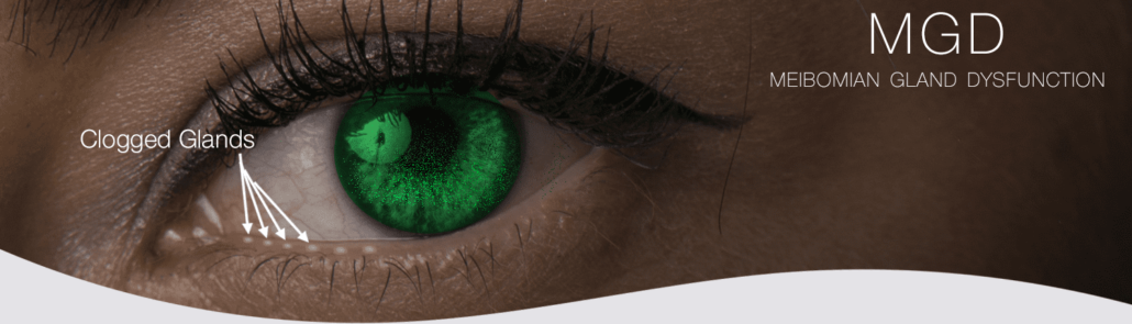 Meibomian Gland Dysfunction - Eyecare Virginia Beach